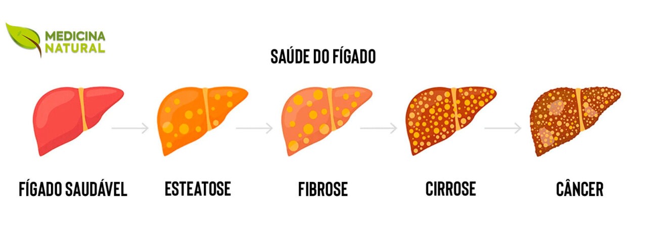 Gordura no fígado: Causas, sintomas, como tratar e eliminar
